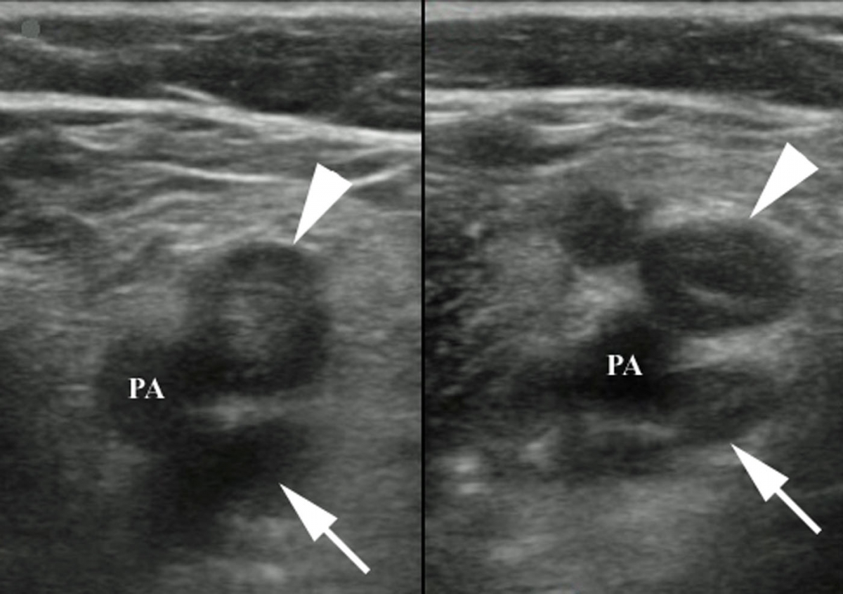 Deep Vein Thrombosis – John Snyder, DPT