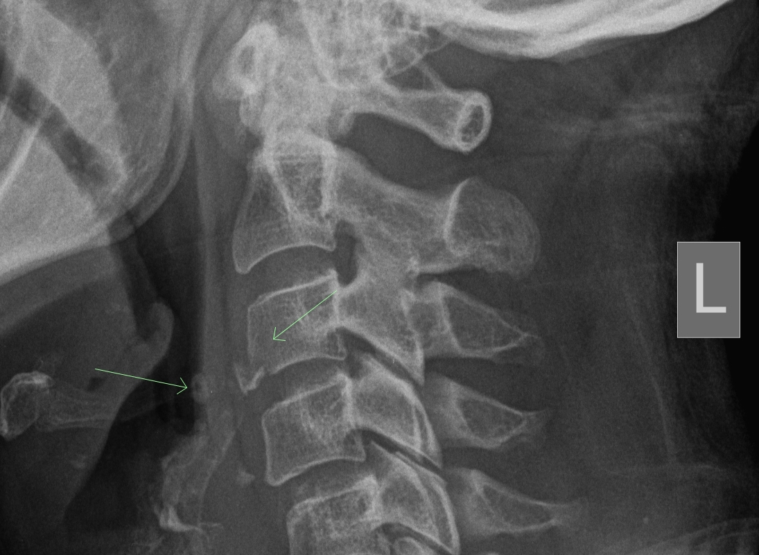 Closed Cervical Fractures – John Snyder, DPT