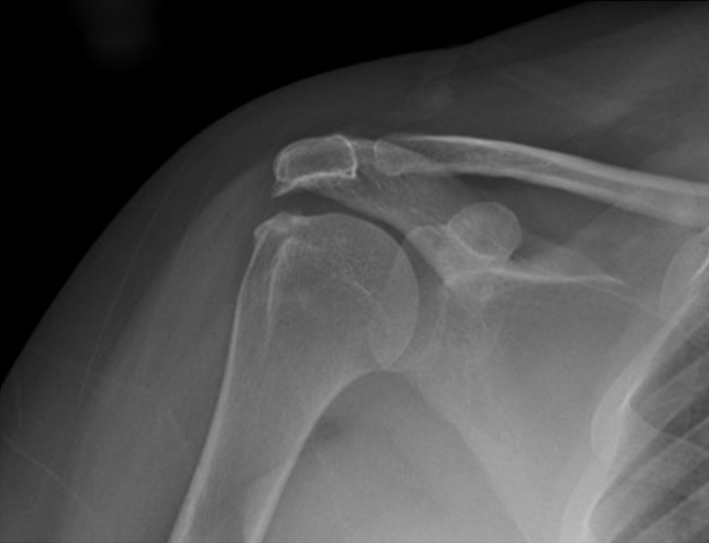Subacromial Impingement – John Snyder, DPT