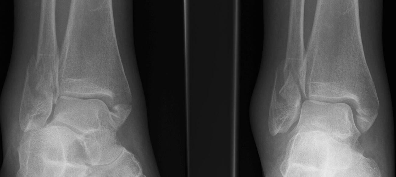 Ottawa Ankle Rules – John Snyder, DPT